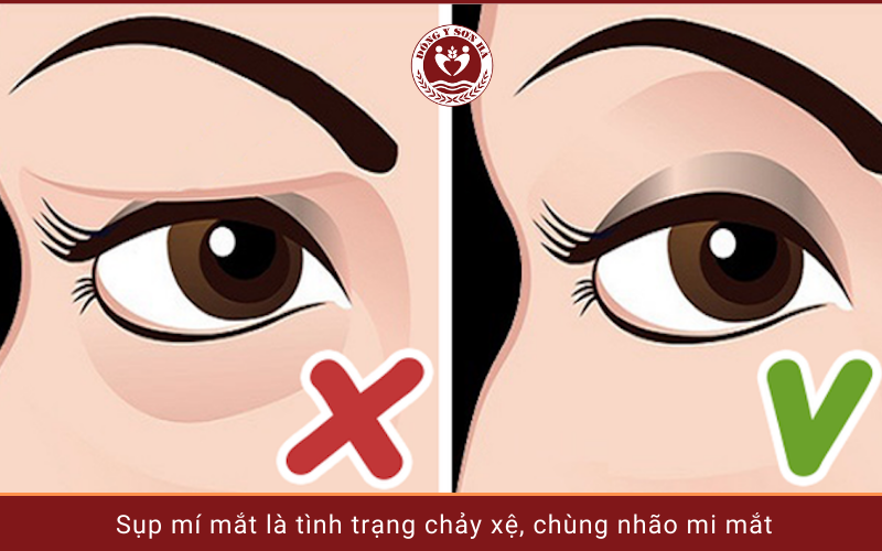 Bật mí 5 cách massage mắt chống sụp mí mắt hiệu quả tại nhà